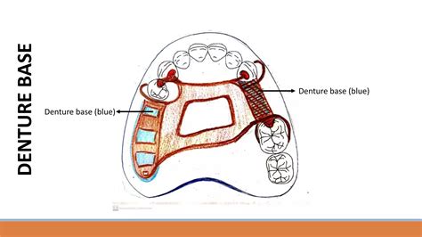 Applied Aspects Of Cast Partial Denture Designingpptx