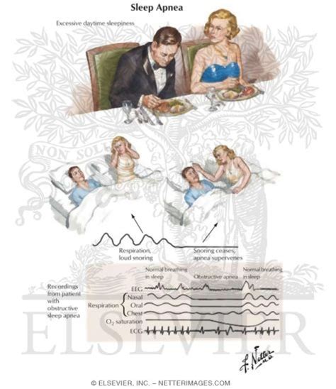 Sleep Apnea