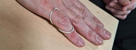 Swan Neck Deformity Managing It With Orthopedic Silver Ring Splints Jewel Splint