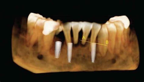 Ai Based Segmentation Of Implants And Crowns Can Improve Pre Surgical Planning For Implants