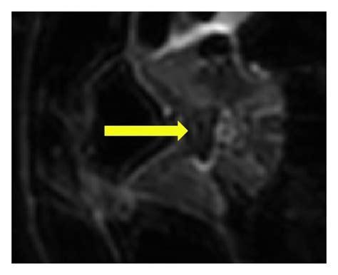 Representative T2 Weighted Sagittal Mri Of The Nucleus Pulposus At The Download Scientific