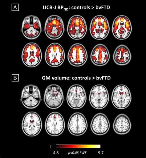 Synaptic Loss And Atrophy In Patients With Behavioral Variant Of Download Scientific Diagram