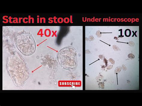Starch In Urine
