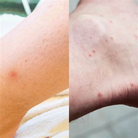 Flohbisse Vs Bettwanzenbisse Symptome Und Unterschiede Nzlyfz
