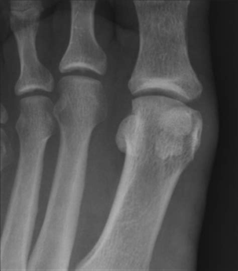 Sesamoid Bone Fracture