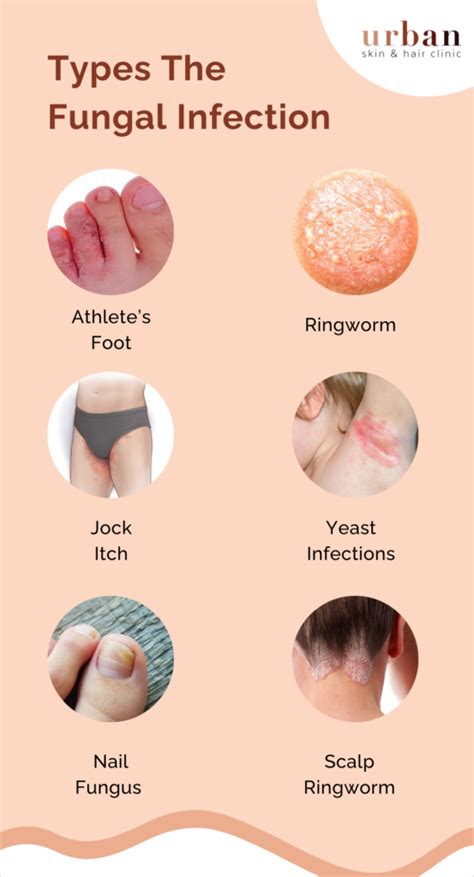 Fungal Skin Rash Treatment