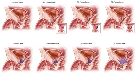 Guide To Types Of Prostate Surgery How To Choose