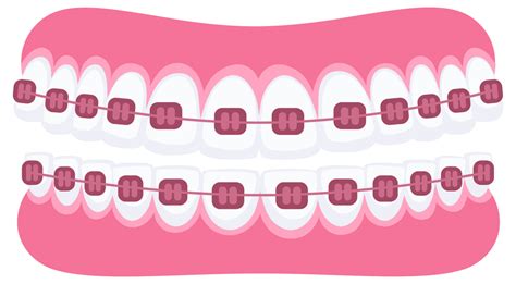 Dental Braces Pngs For Free Download