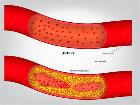 Premium Vector Realistic Type Of Cholesterol In Artery Isolated