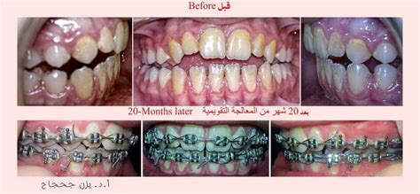 Dr Yazan Jahjaha On Linkedin Treatment Follow Up Of Anterior Open