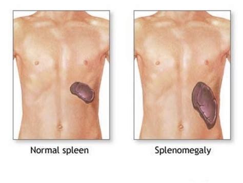 Splenomegaly Symptoms And Causes Medical Article