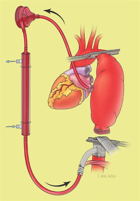 Distal Aortic Perfusion Via After Completion Of The Distal Anastomosis