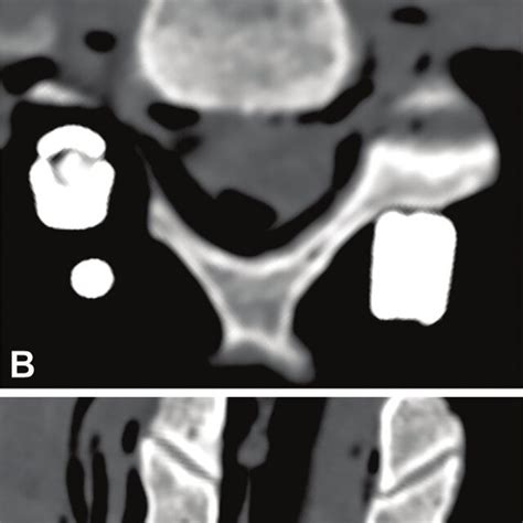 The Application Of A Lateral Mass Prosthesis A There Is No Download Scientific Diagram