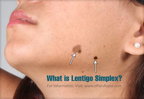 What Is Lentigo Simplex Causes Risk Factors Symptoms Treatment
