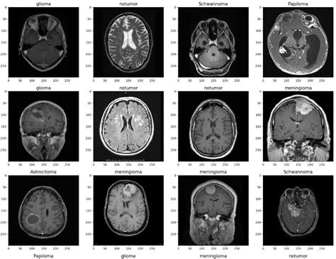 Harsh Maniya On Linkedin Deeplearning Aiinhealthcare Braintumordetection Datascience