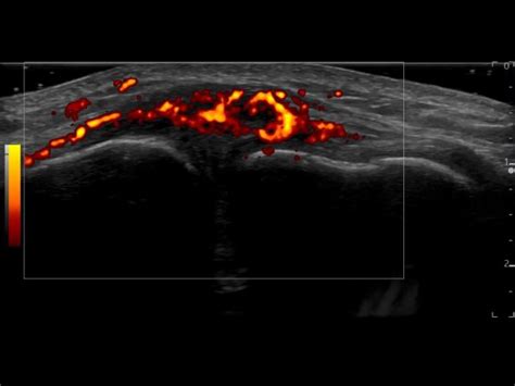 Ac Joint Capsule Sprain And Synovitis Ultrasound Cases