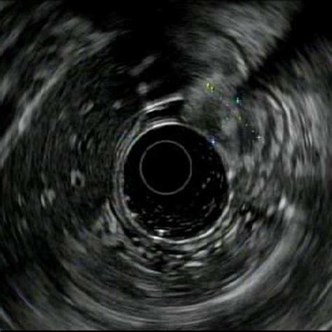 Sessile Polyp Seen In The Anterior Gastric Body On Upper Endoscopy Download Scientific Diagram
