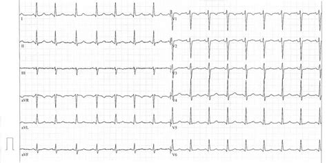 Hypocalcemia Ekg