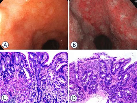 Gastric Intestinal Metaplasia Endoscopic A B And Histological C
