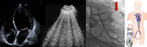 Cardiogenic Shock Recapem