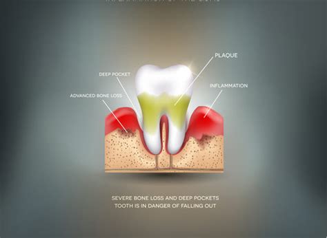 Parodontiti Identificato Meccanismo Protettivo Popular Science