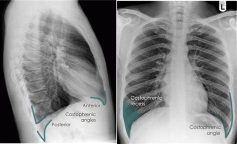 Costophrenic Angle