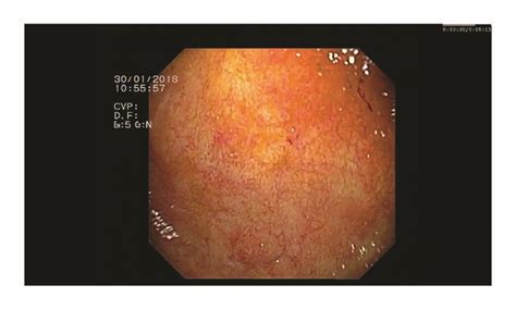 Representative Endoscopy Images A Initial Ileoscopy Showing Download Scientific Diagram