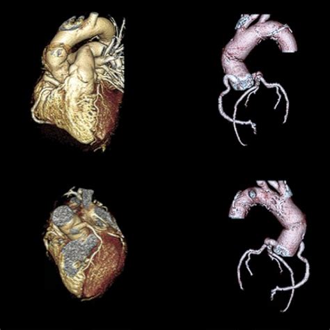 Pdf Aortic Root Reconstruction With A New Dacron Graft Featuring
