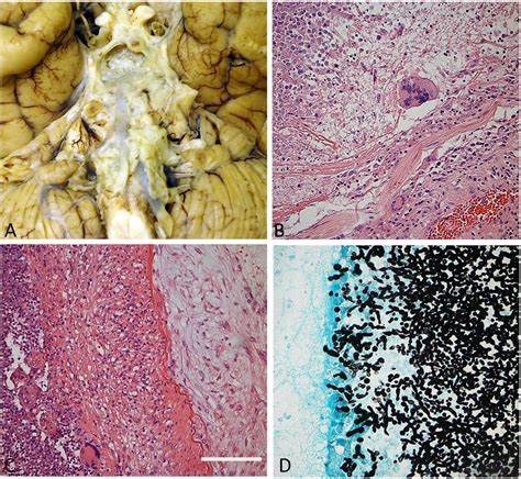 Intradural Extramedullary Spinal Candida Infection Practical Neurology