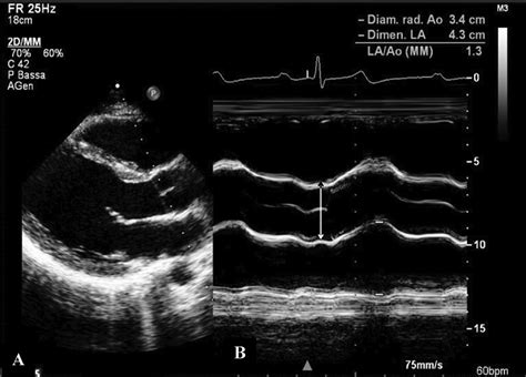Prevalence And Clinical Significance Of Aortic Root Dilation In Highly