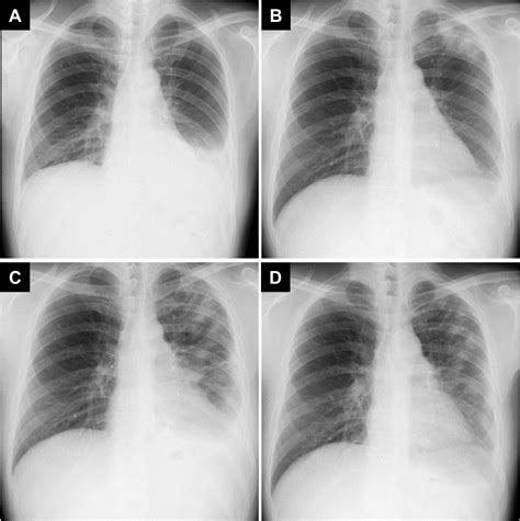 Lung Consolidation Vs Pleural Effusion