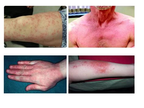 Occupational Dermatitis Pptx