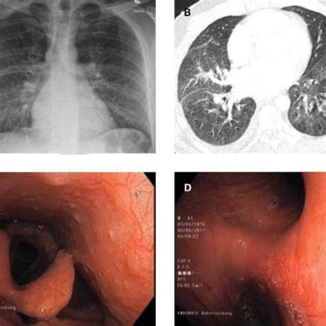 Imaging And Bronchoscopy Findings Description In Text Download