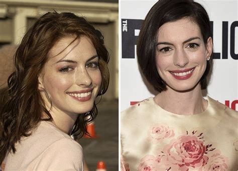 Anne Hathaway Before And After Plastic Surgery Boobs Nose Face Lips