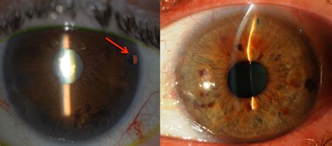 Glaucoma Information Occludable Angle Glaucoma Information