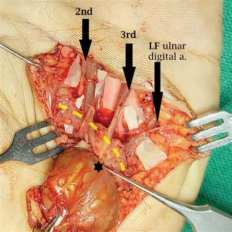 The Smaller Pseudoaneurysm Arrow Exposed After Resection Of The Download Scientific Diagram