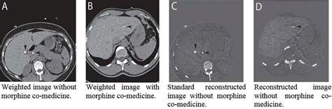 Case For A Male Patient At 69 Years Old Which Had Hypervascular Lesion
