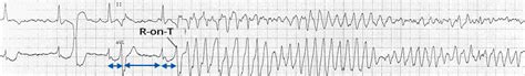 Torsades De Pointes Tdp Ecg