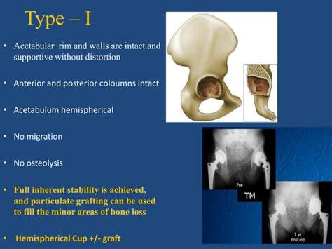 Acetabular Defects Pptx