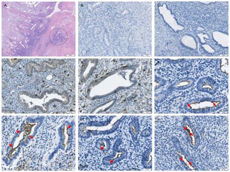 Eutopic And Ectopic Endometrial Interleukin 17 And Interleukin 17