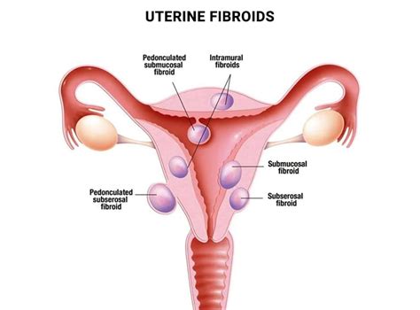 Uterus Fibroid