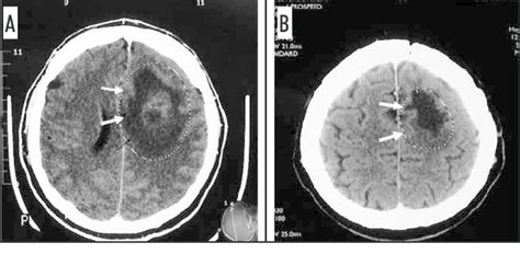 Computer Tomography Image Ct Of Human Brain Tumor Marked With Dashed