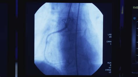145 Vascular Catheterization Stock Videos Footage And 4k Video Clips Getty Images