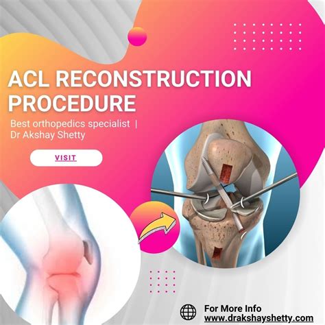 Understanding The Acl Reconstruction Procedure A Step By Step Guide