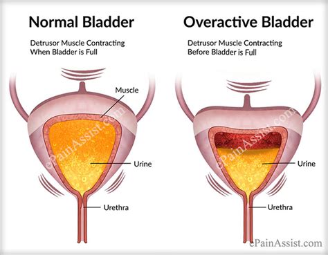 Bladder Training For Women To Prevent Overactive Bladder And Incontinence