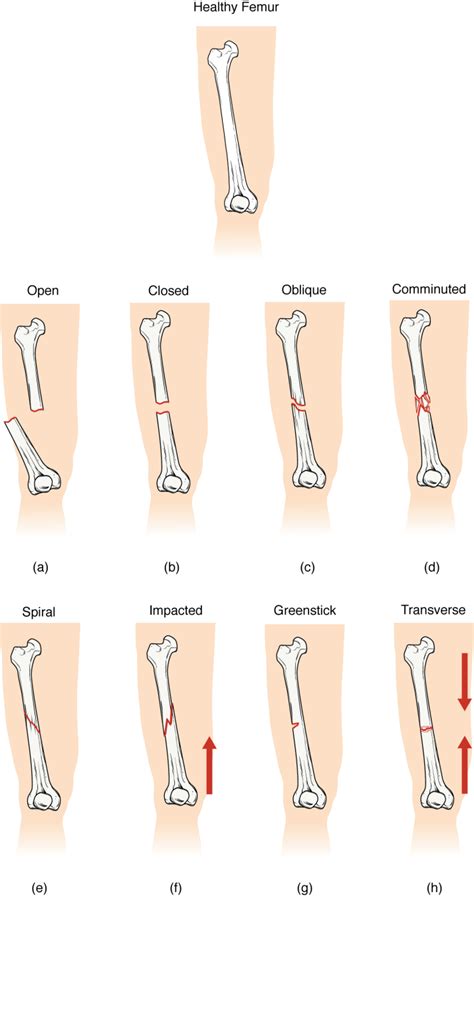 6 5 Fractures Bone Repair Anatomy Physiology