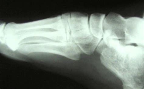 Stage 4 Bone Cancer Survival Rates