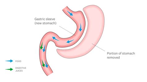 Stomach Surgery For Weight Loss Discover Weight Loss