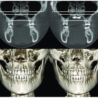 Linear Measurements Of The Maxilla Before And After Download