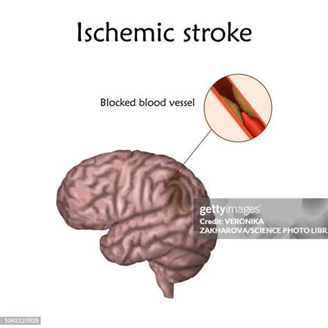 Ischemic Stroke Illustration High Res Vector Graphic Getty Images